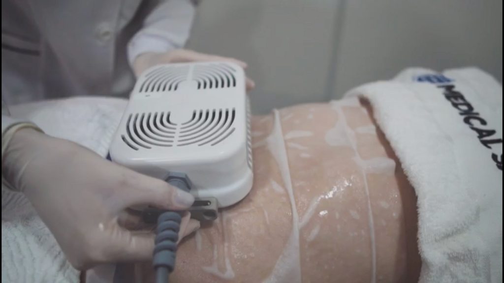 Criodermis: como funciona a criolipólise de placas da Medical San | BCMED