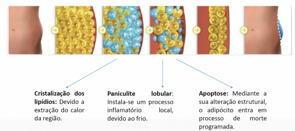 Desvendando a criolipólise: conheça os tipos de aparelhos no mercado ...