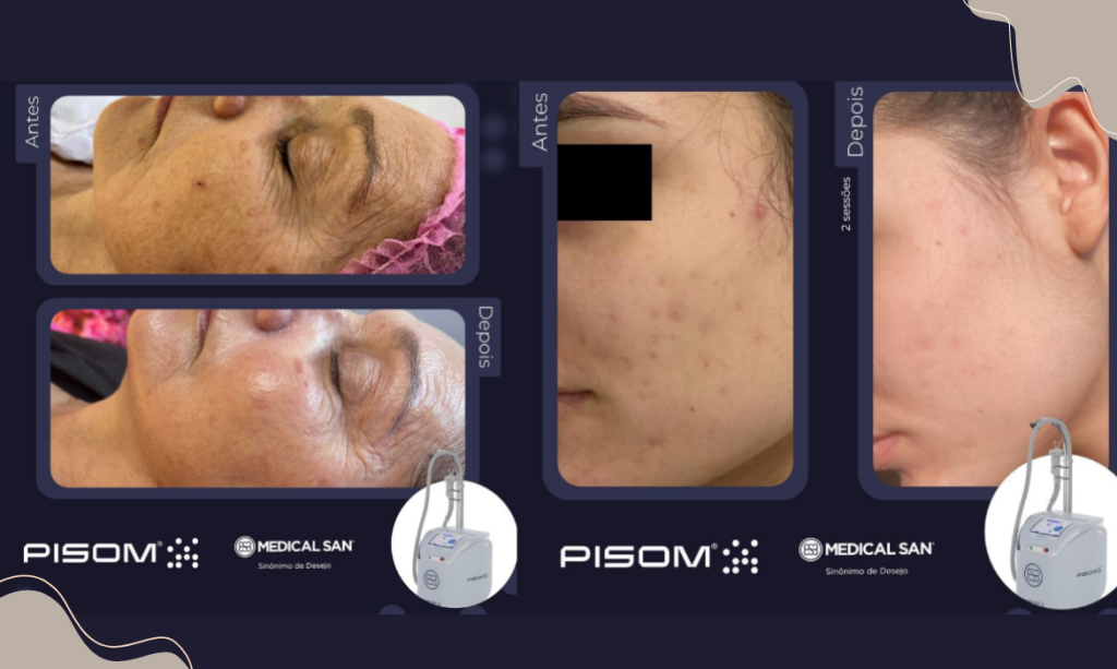 Você conhece o Pisom? Único aparelho com Laser de Thulium e Erbium para ...