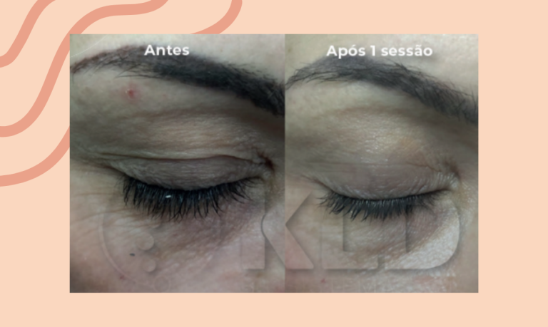 Jato de Plasma para Rejuvenescimento: Como Funciona e Quais Resultados Esperar? | BCMED